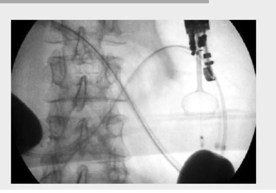 How to perform endoscopic gastroenterostomy using novel lumen-apposing ...