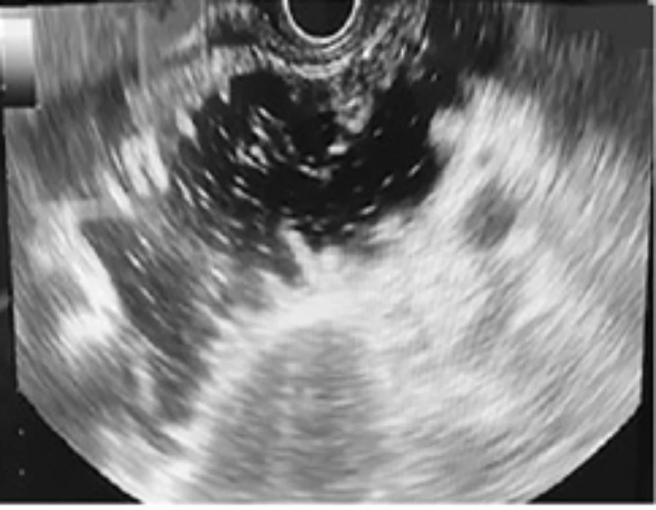 How to perform endoscopic gastroenterostomy using novel lumen-apposing ...