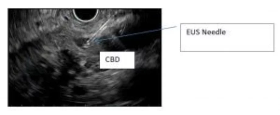 Successful EUS-guided rendezvous ERCP | World Endoscopy Organization