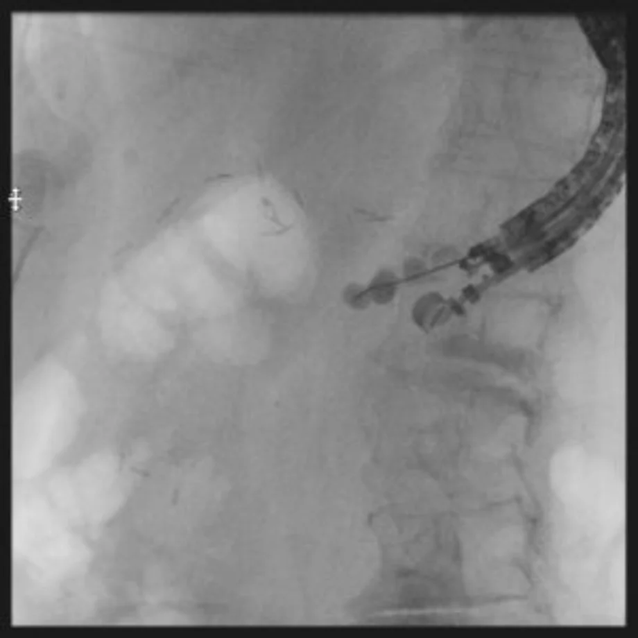 Successful EUS-guided rendezvous ERCP | World Endoscopy Organization